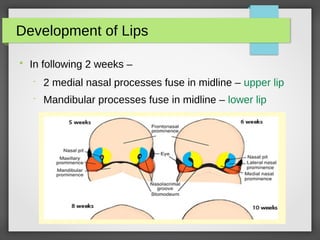 Cleft Lip and Palate | PPT
