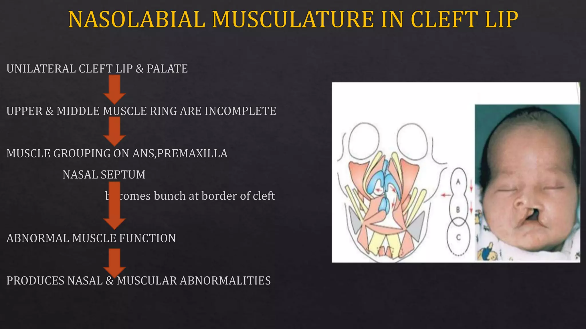 Cleft lip and palate | PPTX | Ear, Nose and Throat Conditions ...