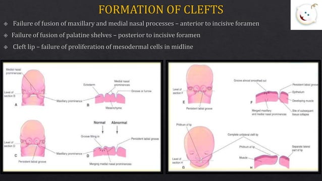 Cleft lip and palate | PPTX | Ear, Nose and Throat Conditions ...