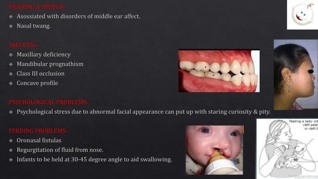Cleft lip and palate | PPTX | Ear, Nose and Throat Conditions ...
