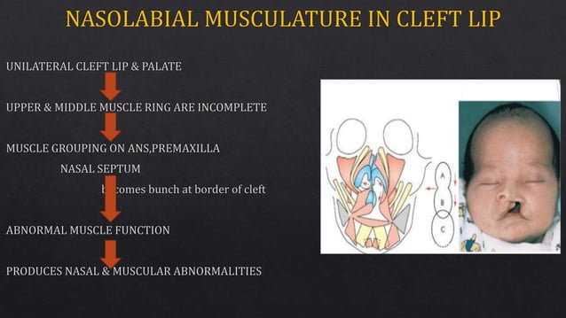 Cleft lip and palate | PPTX | Ear, Nose and Throat Conditions ...