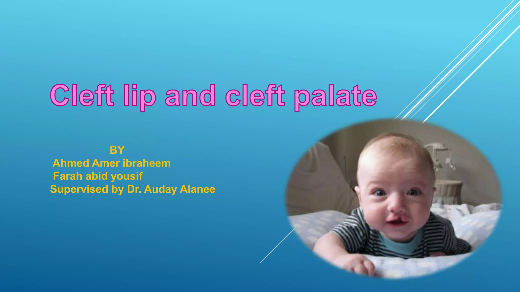 Cleft lip and palate | PPT