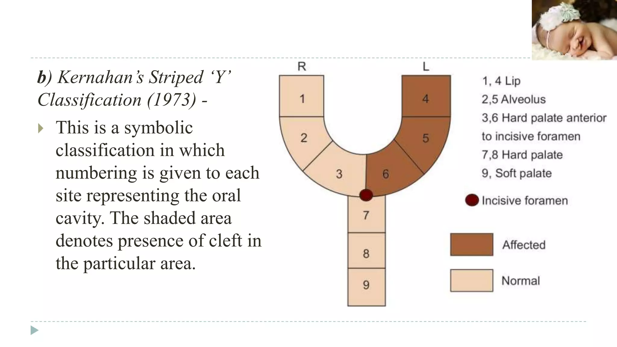 Cleft lip and palate | PPTX