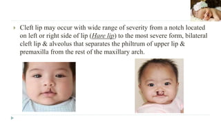 Cleft lip and palate | PPTX