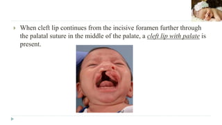 Cleft lip and palate | PPTX