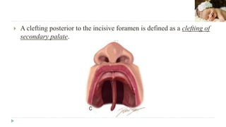 Cleft lip and palate | PPTX