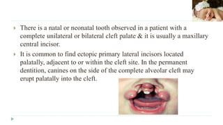 Cleft lip and palate | PPTX