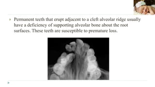Cleft lip and palate | PPTX