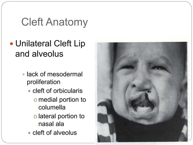 Cleft lip and palate ----- | PPTX