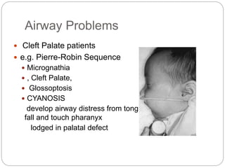Cleft lip and palate ----- | PPTX