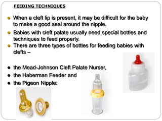 Cleft lip and palate ----- | PPT