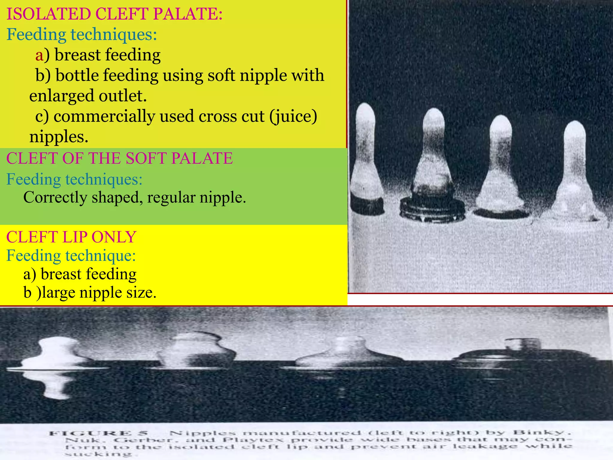 CLEFT LIP AND PALATE.pptx