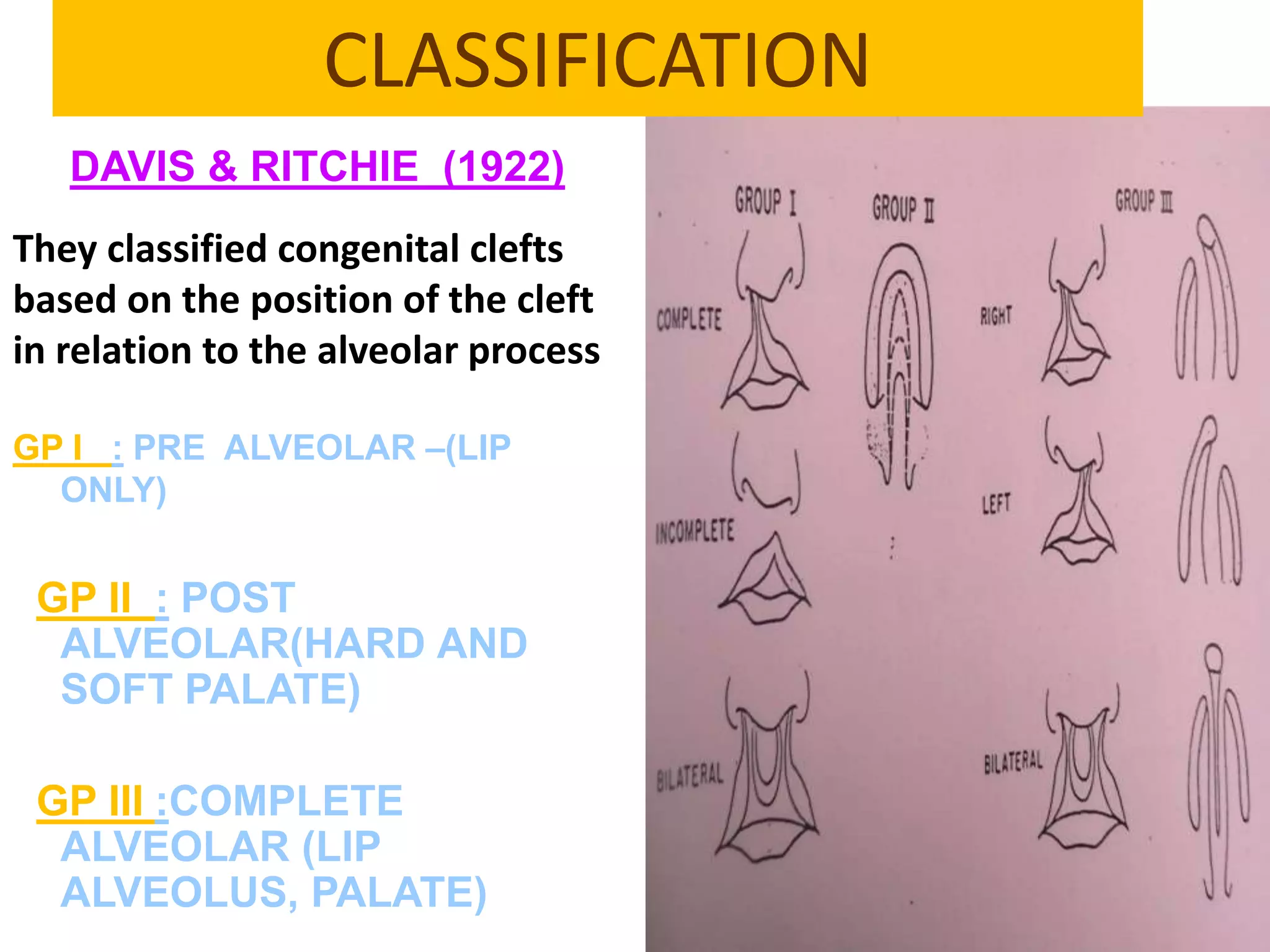 CLEFT LIP AND PALATE.pptx