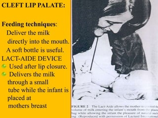 CLEFT LIP AND PALATE.pptx