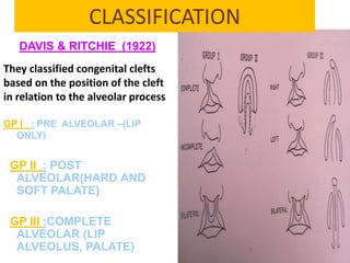 CLEFT LIP AND PALATE.pptx | Dental Health | Diseases and Conditions