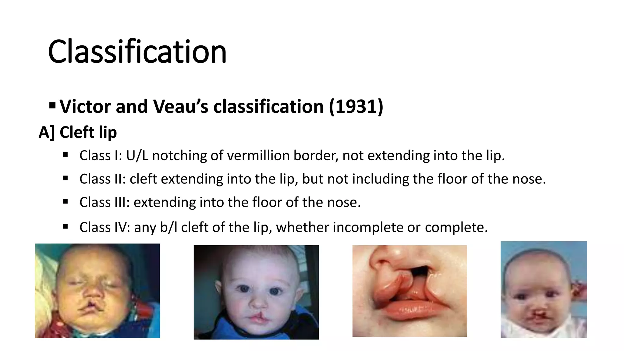 CLEFT LIP AND PALATE.pptx