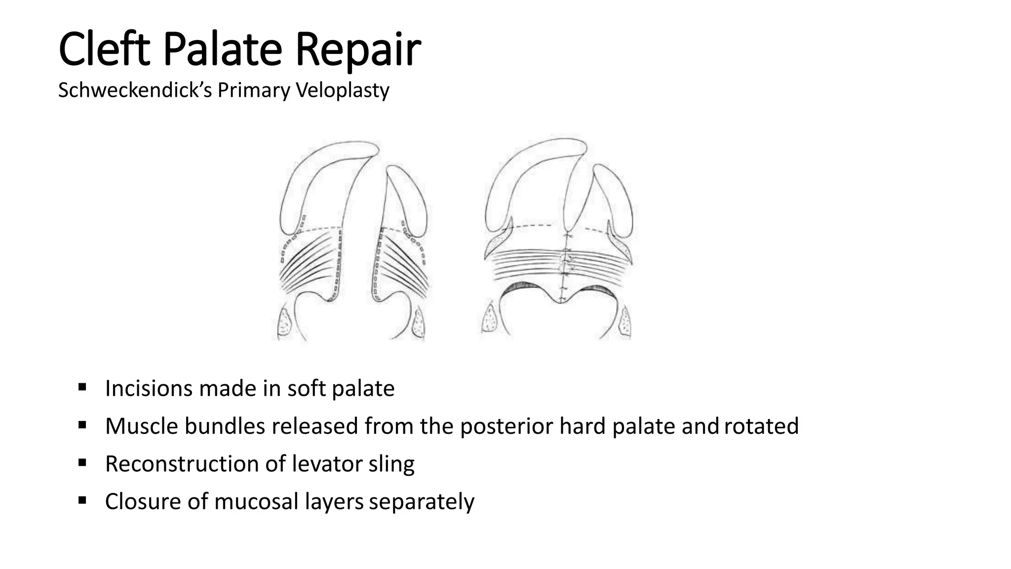 CLEFT LIP AND PALATE.pptx