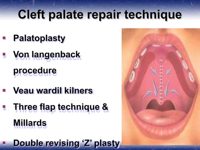 CLEFT LIP AND PALATE.pptx