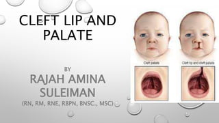 Cleft lip and palate.ppt