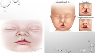 Cleft lip and palate.ppt