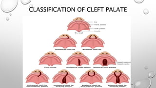 Cleft lip and palate.ppt