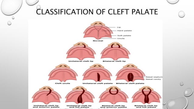 Cleft lip and palate.ppt