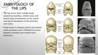 Cleft lip and palate.ppt