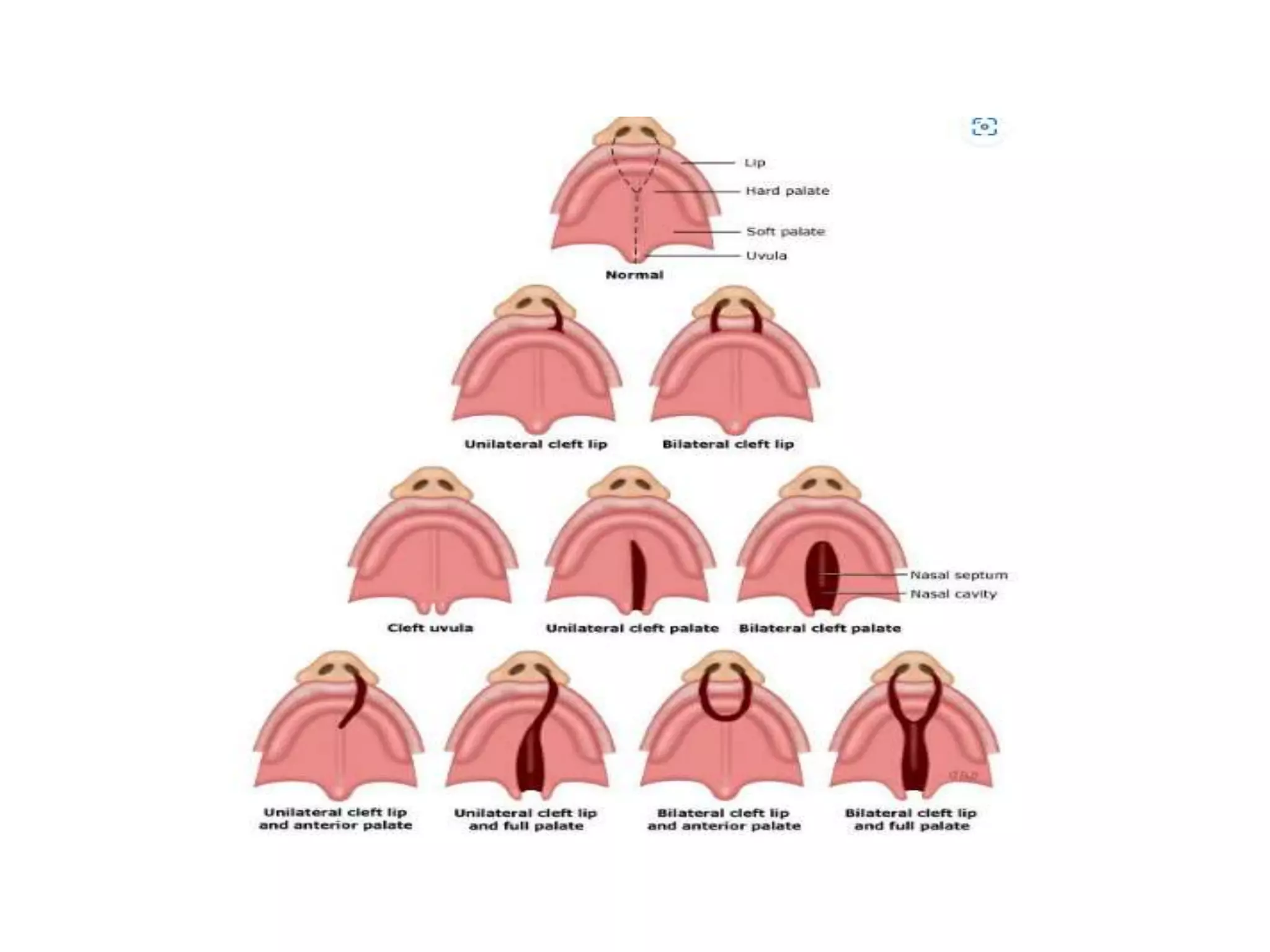 Cleft lip and palate.pptx