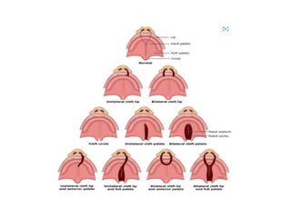 Cleft lip and palate.pptx