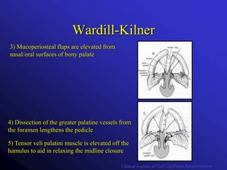 Cleft lip and palate.pptx