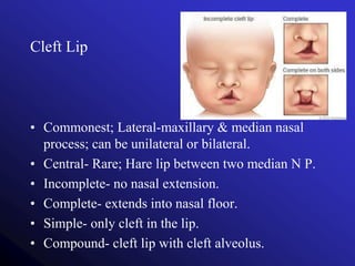 Cleft lip and palate.pptx