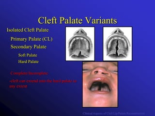 Cleft lip and palate.pptx