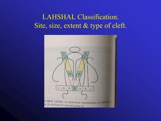 Cleft lip and palate.pptx