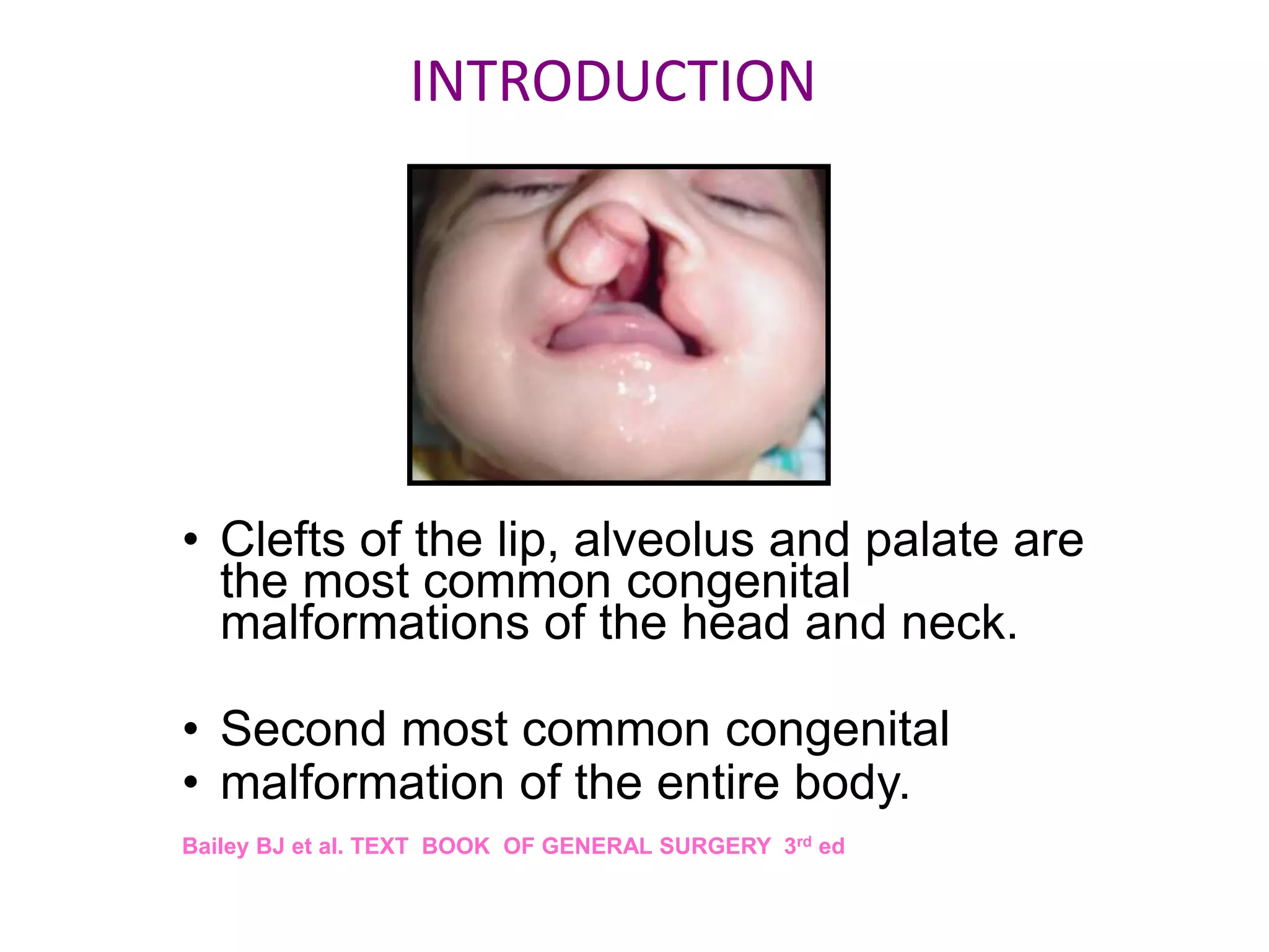 CLEFT LIP AND PALATE.ppt