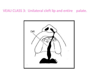CLEFT LIP AND PALATE.ppt