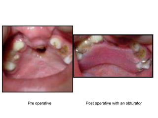 CLEFT LIP AND PALATE.ppt