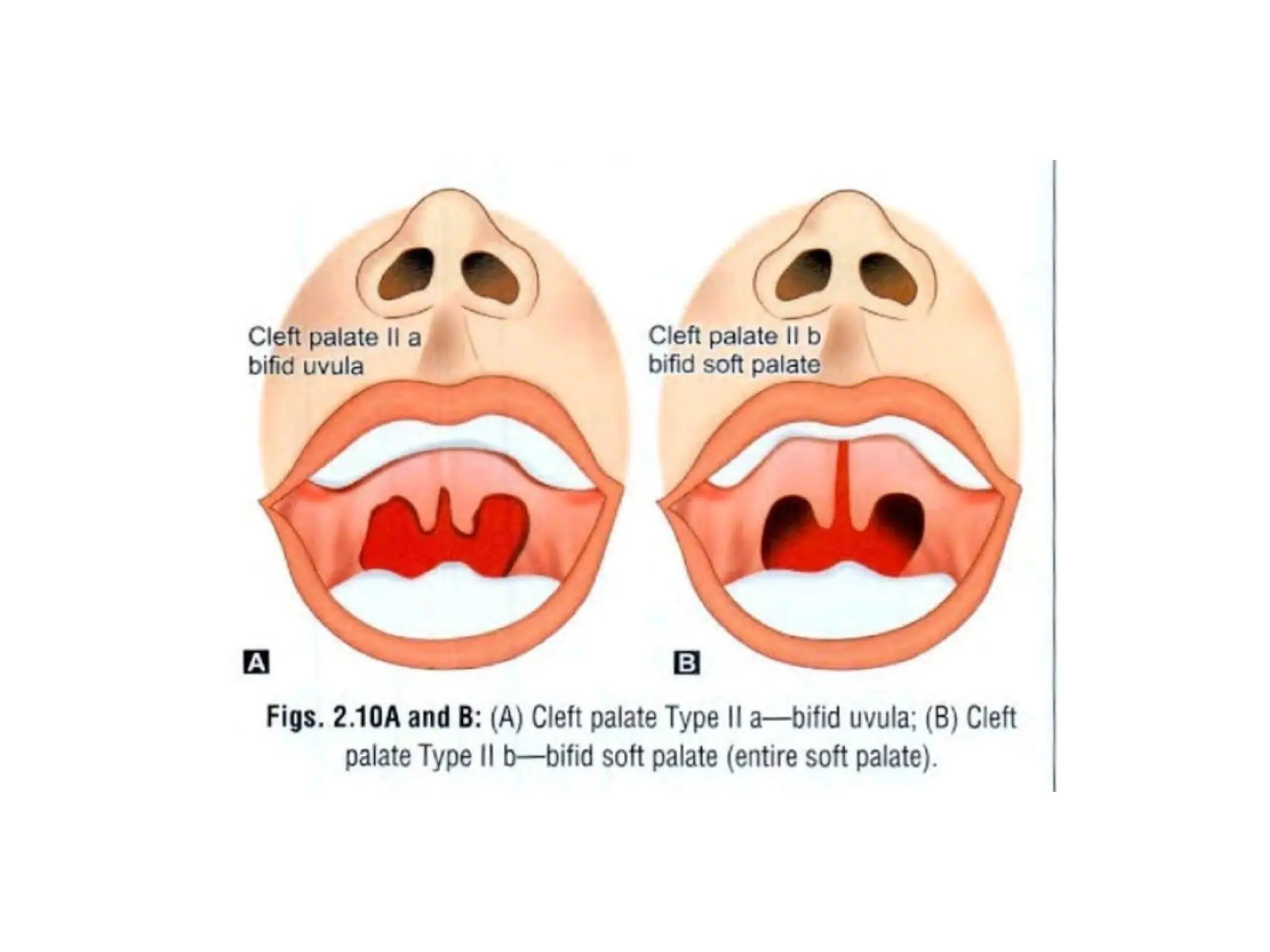 CLEFT LIP AND CLEFT PALATE- Embryology and management | PPTX