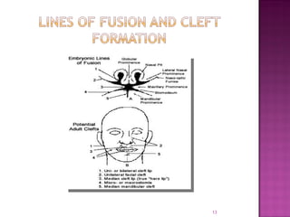 CLEFT LIP AND PALATE - etiology and managemnt | PPT