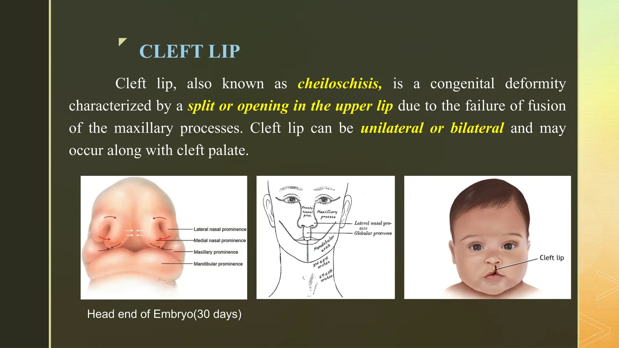 CLEFT LIP AND PALATE: NURSING MANAGEMENT.pptx