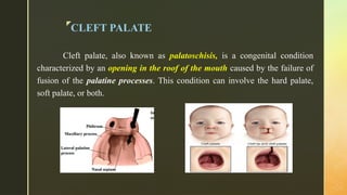 CLEFT LIP AND PALATE: NURSING MANAGEMENT.pptx