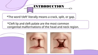 cleft lip and palate Management of Cleft Lip and Palate | PPTX