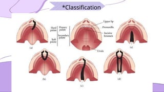 cleft lip and palate Management of Cleft Lip and Palate | PPTX