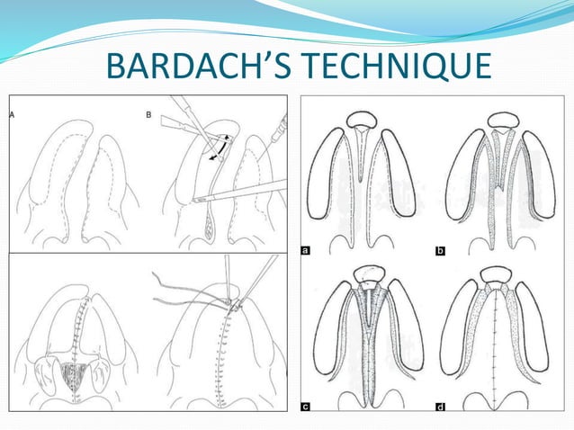 CLEFT LIP AND PALATE craniofacial anomalies | PPT