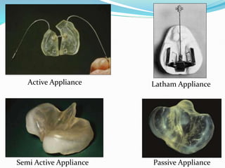 CLEFT LIP AND PALATE craniofacial anomalies | PPT