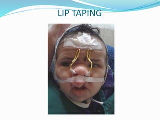 CLEFT LIP AND PALATE craniofacial anomalies | PPTX