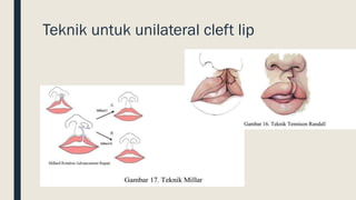 Cleft lip and palate | PDF