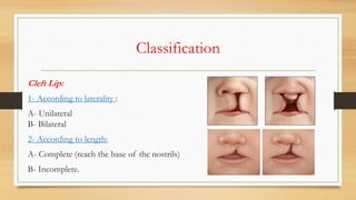 cleft lip and palate 1.pptx