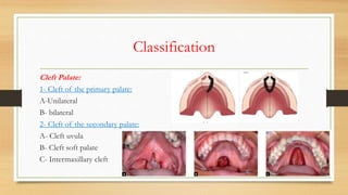 cleft lip and palate 1.pptx