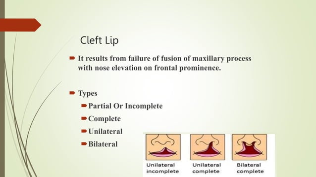 cleft lip and palate1.pptx
