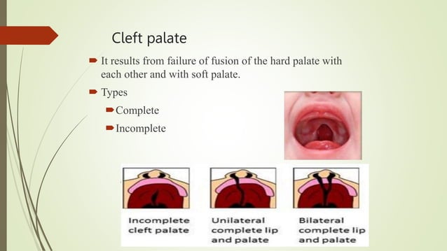 cleft lip and palate1.pptx